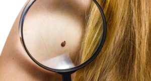 Understanding Mole Mapping in Dermatology