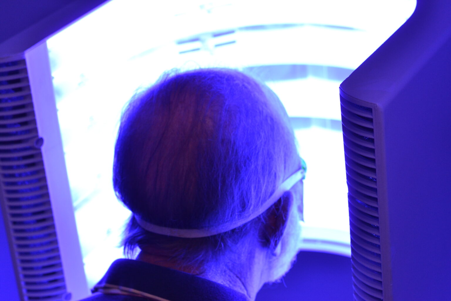 Should I Consider Photodynamic Therapy for My Actinic Keratosis?