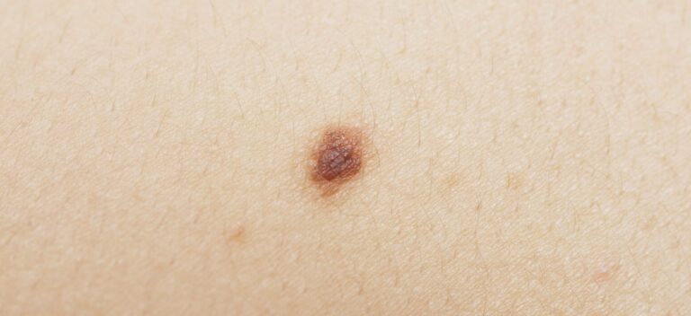 Birthmarks and Skin Cancer: What is the Risk of My Child’s Mole ...